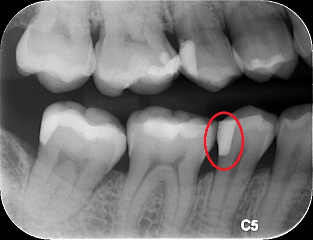 Services in Dentistry Part 5: Dental X-rays – Dr. Bridget Han's Dental Blog
